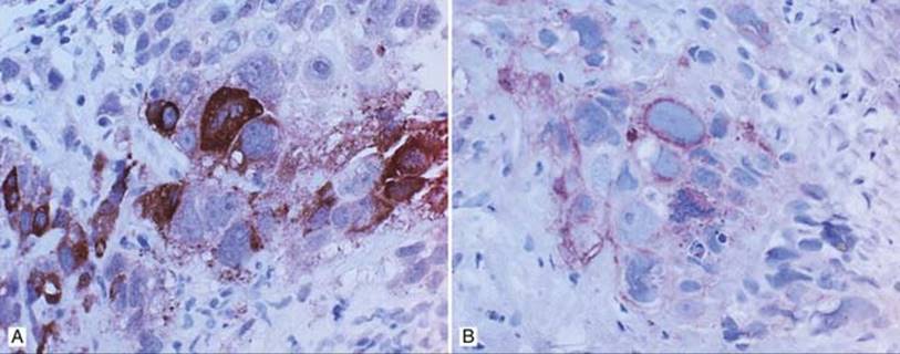 Pleomorphic Carcinoma - Thoracic Pathology: A Volume in the High Yield ...