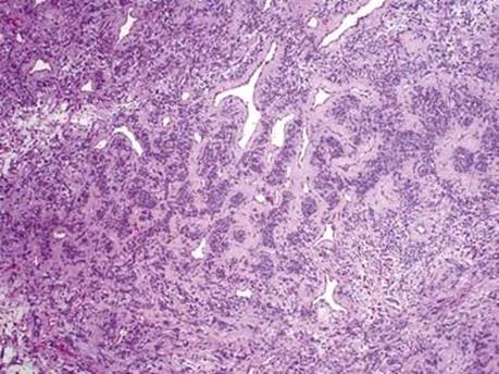 Solitary Fibrous Tumor (SFT) Of The Lung - Thoracic Pathology: A Volume ...