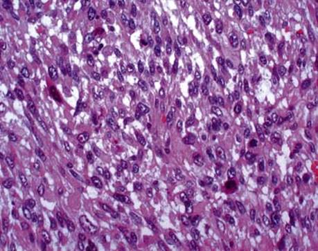 Metastatic Adult Sarcomas - Thoracic Pathology: A Volume in the High ...