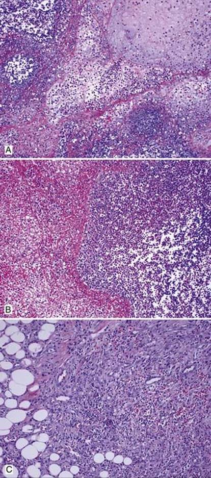 Pleuritis - Thoracic Pathology: A Volume in the High Yield Pathology ...