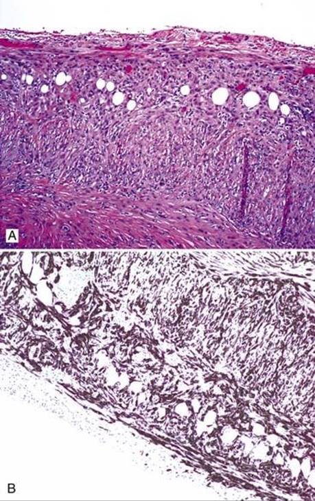 Sarcomatoid Malignant Mesothelioma - Thoracic Pathology: A Volume in ...