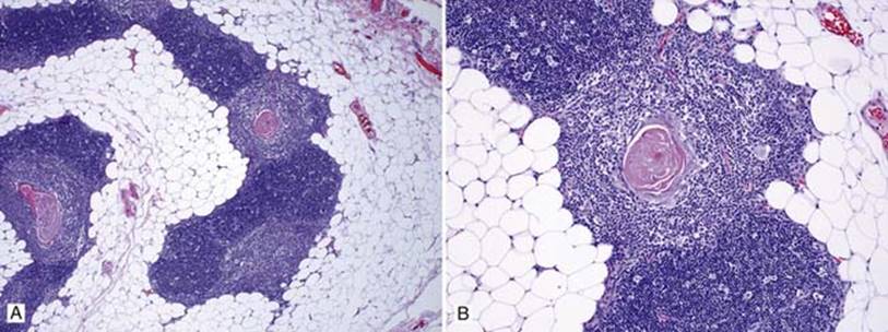 Normal Thymus - Thoracic Pathology: A Volume in the High Yield ...
