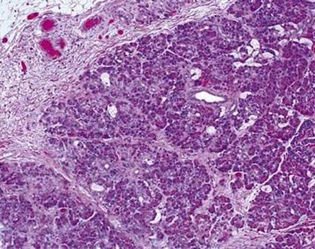 Mediastinal Gastroenteric Cyst - Thoracic Pathology: A Volume in the ...