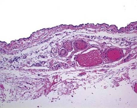 Pericardial Cyst - Thoracic Pathology: A Volume in the High Yield ...