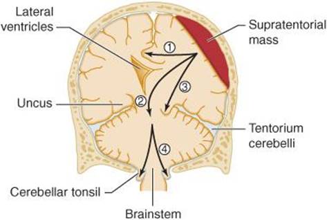 Coma - Clinical Neurology, 8th Ed.