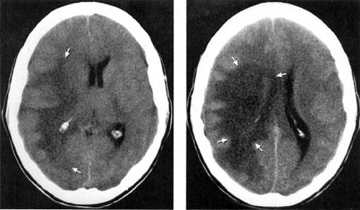 Acute White Matter Diseases - Catastrophic Neurologic Disorders in the ...