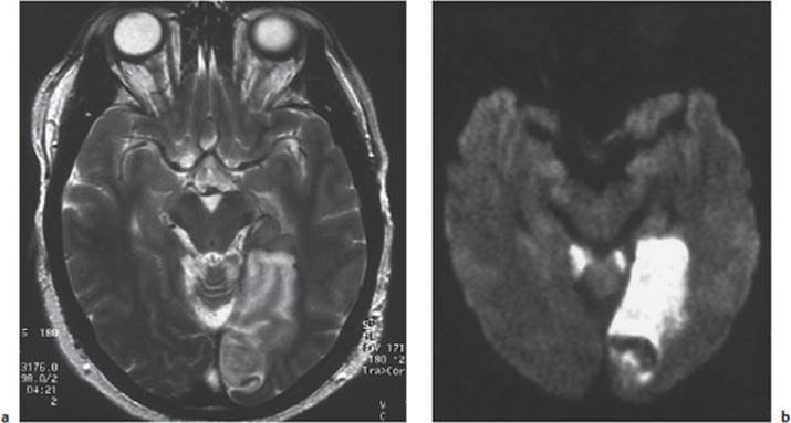 Diseases of the Cranial Nerves - Fundamentals of Neurology: An ...