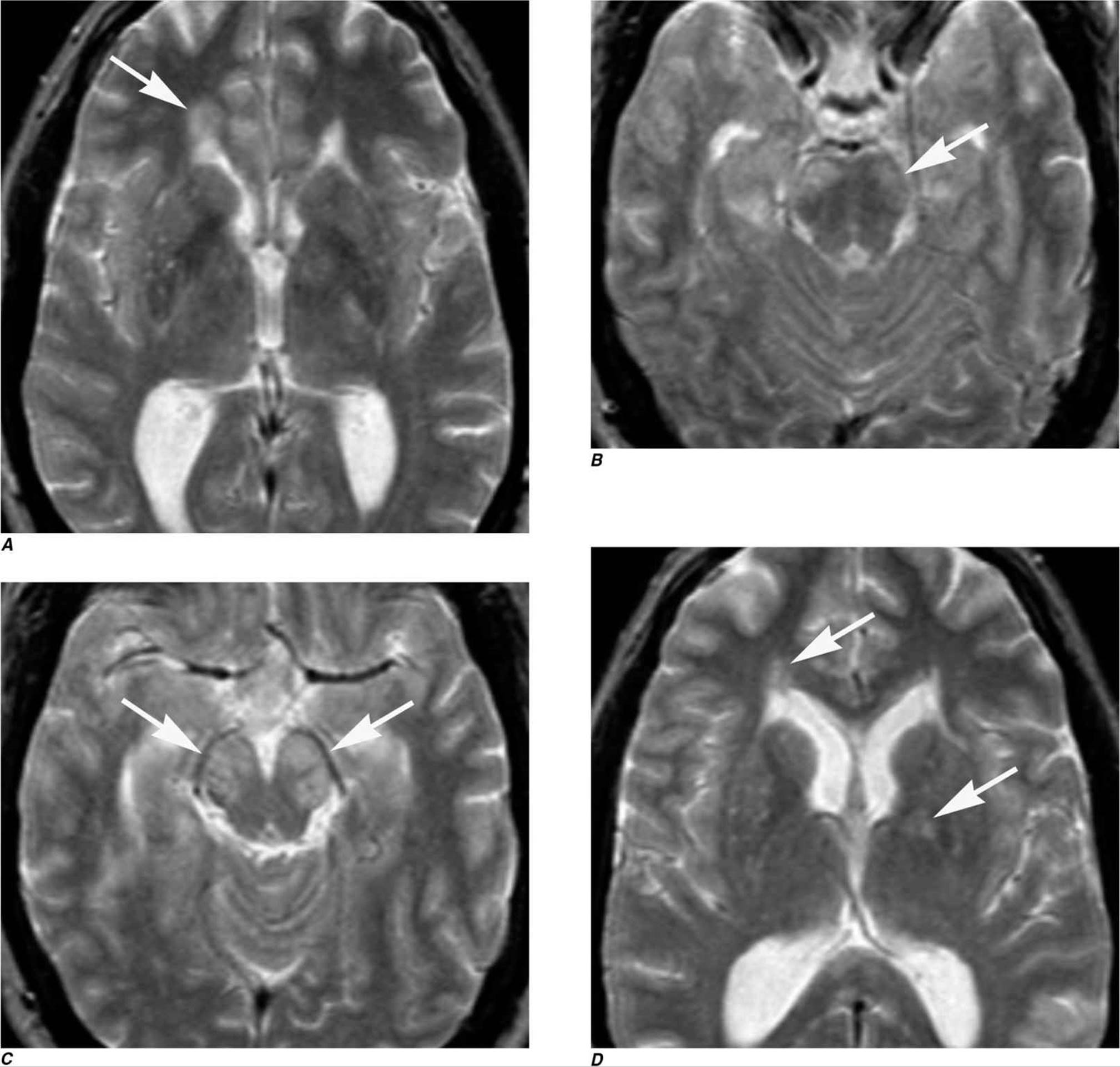 ATLAS OF NEUROIMAGING - DISEASES OF THE NERVOUS SYSTEM - Harrison's ...