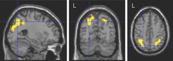 The Localization of Lesions Affecting the Cerebral Hemispheres ...