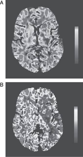 Endovascular Recanalization in Acute Stroke - Neurocritical Care