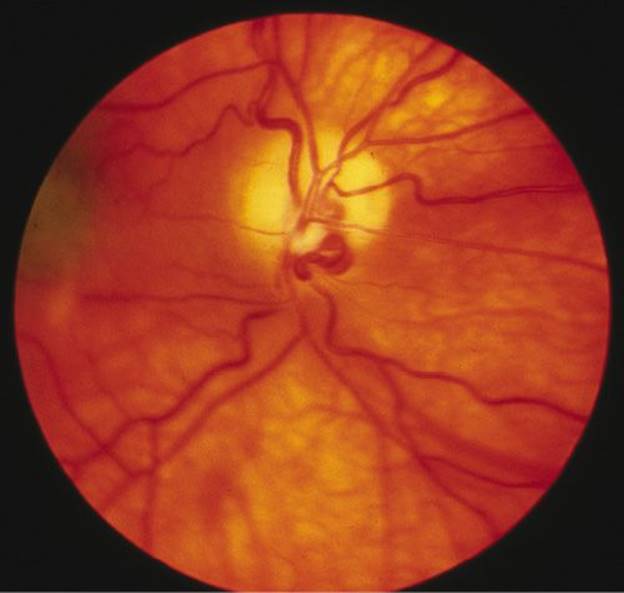 Approach to the Patient with Visual Loss - Practical Neurology, 4th Ed.