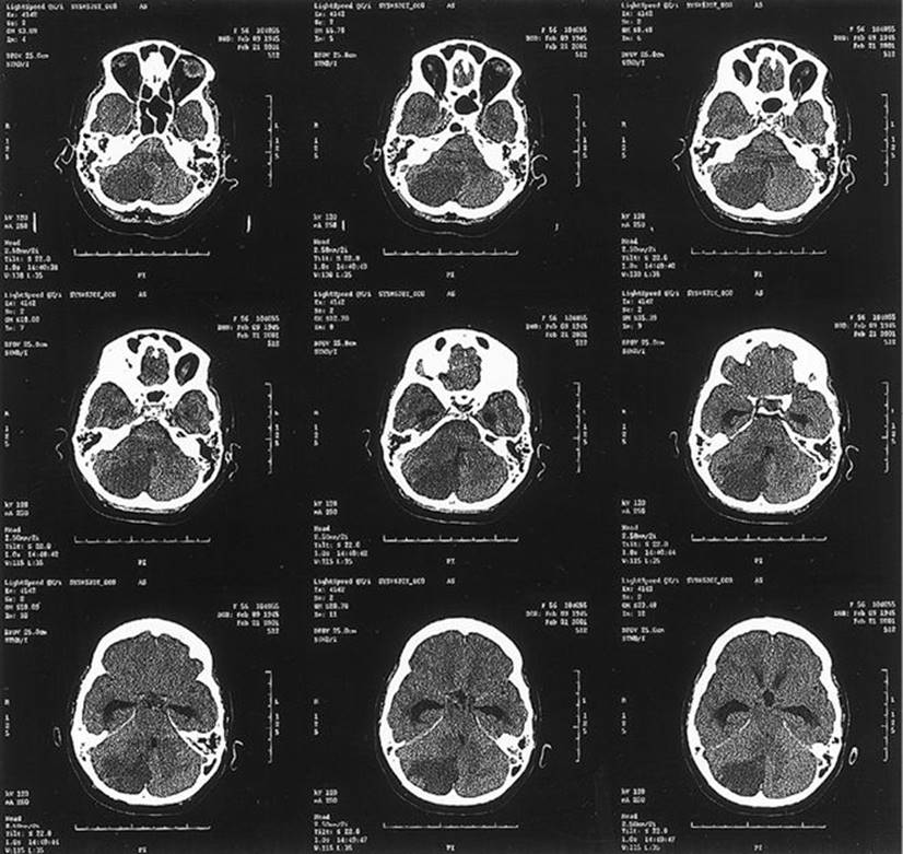 Ischemic Cerebrovascular Disease - Practical Neurology, 4th Ed.