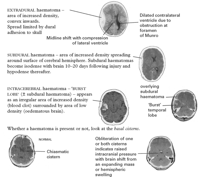 LOCALISED NEUROLOGICAL DISEASE AND ITS MANAGEMENT A. INTRACRANIAL ...