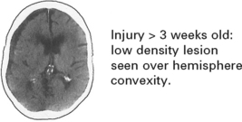 LOCALISED NEUROLOGICAL DISEASE AND ITS MANAGEMENT A. INTRACRANIAL ...