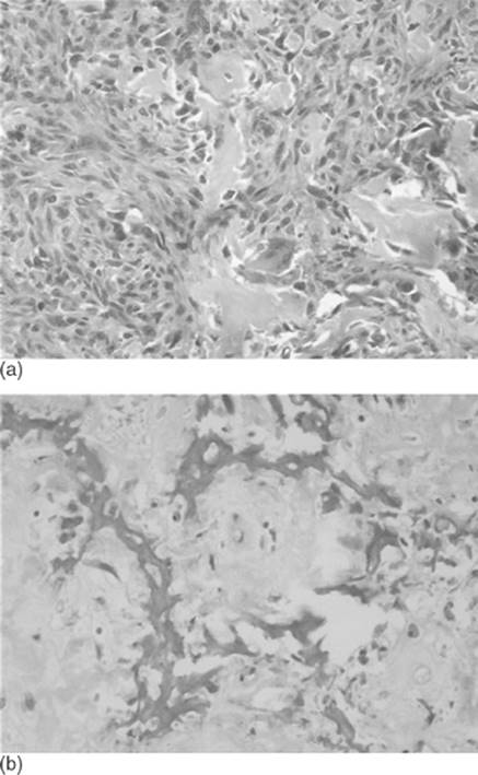 Osteosarcoma - Cancer in Children: Clinical Management, 5th Edition