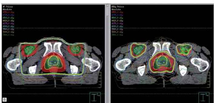 Principles of Radiation Therapy - Gynecologic Oncology: Clinical ...