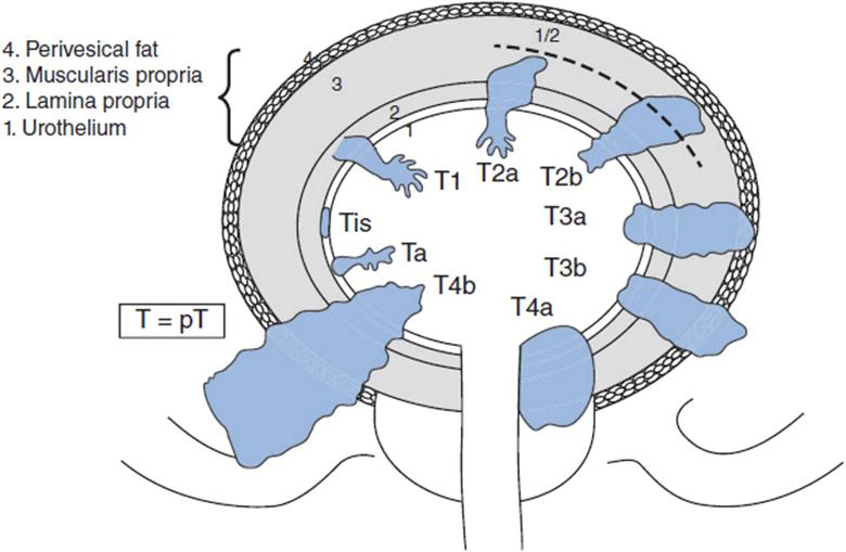 Bladder Cancer - Harrisons Manual of Oncology 2nd Ed.