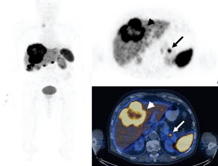 CANCER OF UNKNOWN PRIMARY - Nuclear Oncology, 1 Ed.