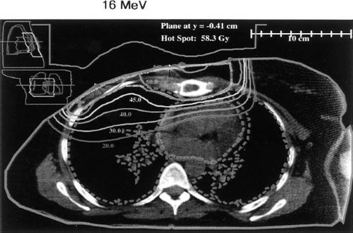 Electron-Beam Therapy Dosimetry, Treatment Planning, and Techniques ...