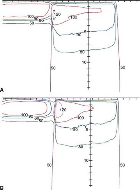 Electron-Beam Therapy Dosimetry, Treatment Planning, and Techniques ...