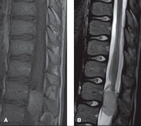 Spinal Canal - Perez & Brady's Principles and Practice of Radiation ...