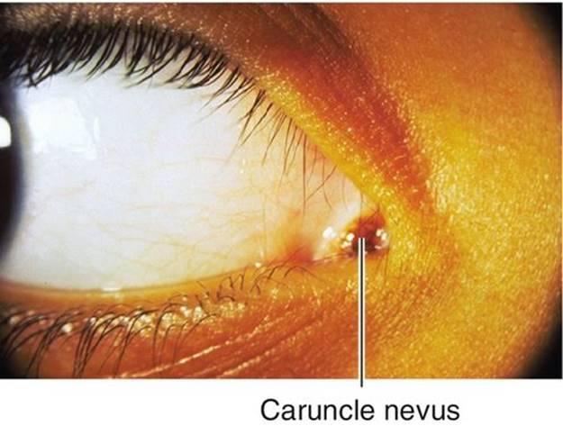Conjunctiva and Sclera - The Massachusetts Eye and Ear Infirmary ...