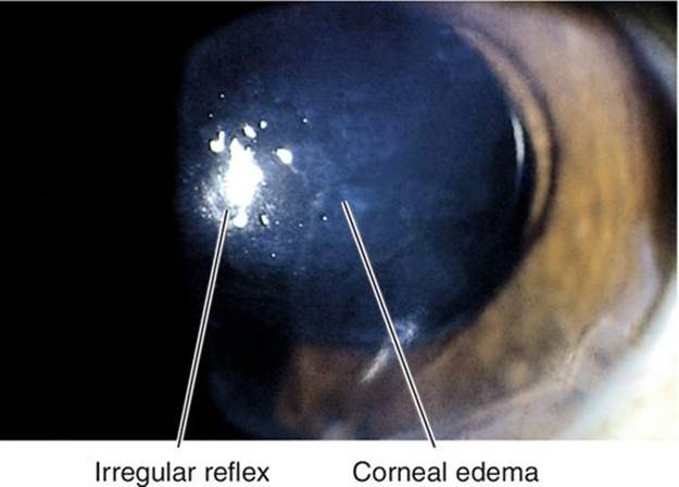Cornea - The Massachusetts Eye and Ear Infirmary Illustrated Manual of ...