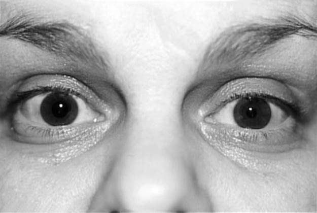 Iris and Pupils - The Massachusetts Eye and Ear Infirmary Illustrated ...