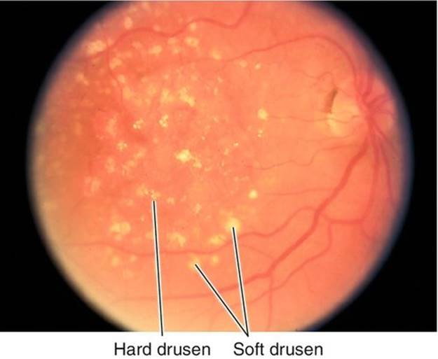Retina and Choroid - The Massachusetts Eye and Ear Infirmary ...