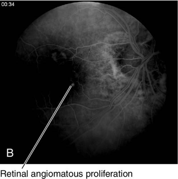 Retina and Choroid - The Massachusetts Eye and Ear Infirmary ...