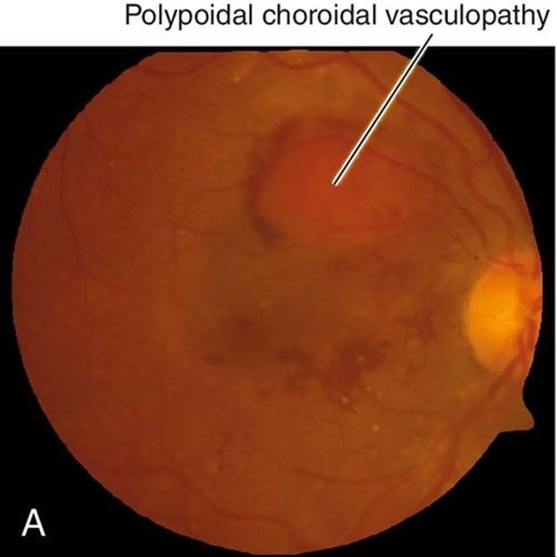 Retina and Choroid - The Massachusetts Eye and Ear Infirmary ...