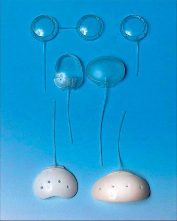 Glaucoma Drainage Implants - GLAUCOMA - Albert & Jakobiec's Principles ...