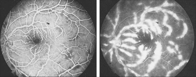 Frosted Branch Angiitis - RETINA AND VITREOUS - Albert & Jakobiec's ...