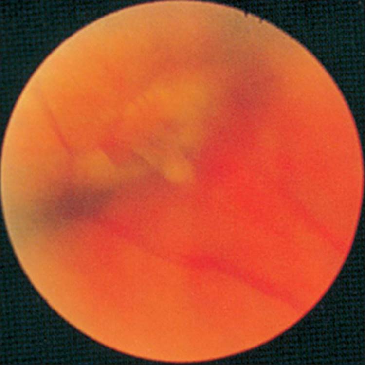 Lattice Degeneration, Cystic Retinal Tufts, Asymptomatic Retinal Breaks ...