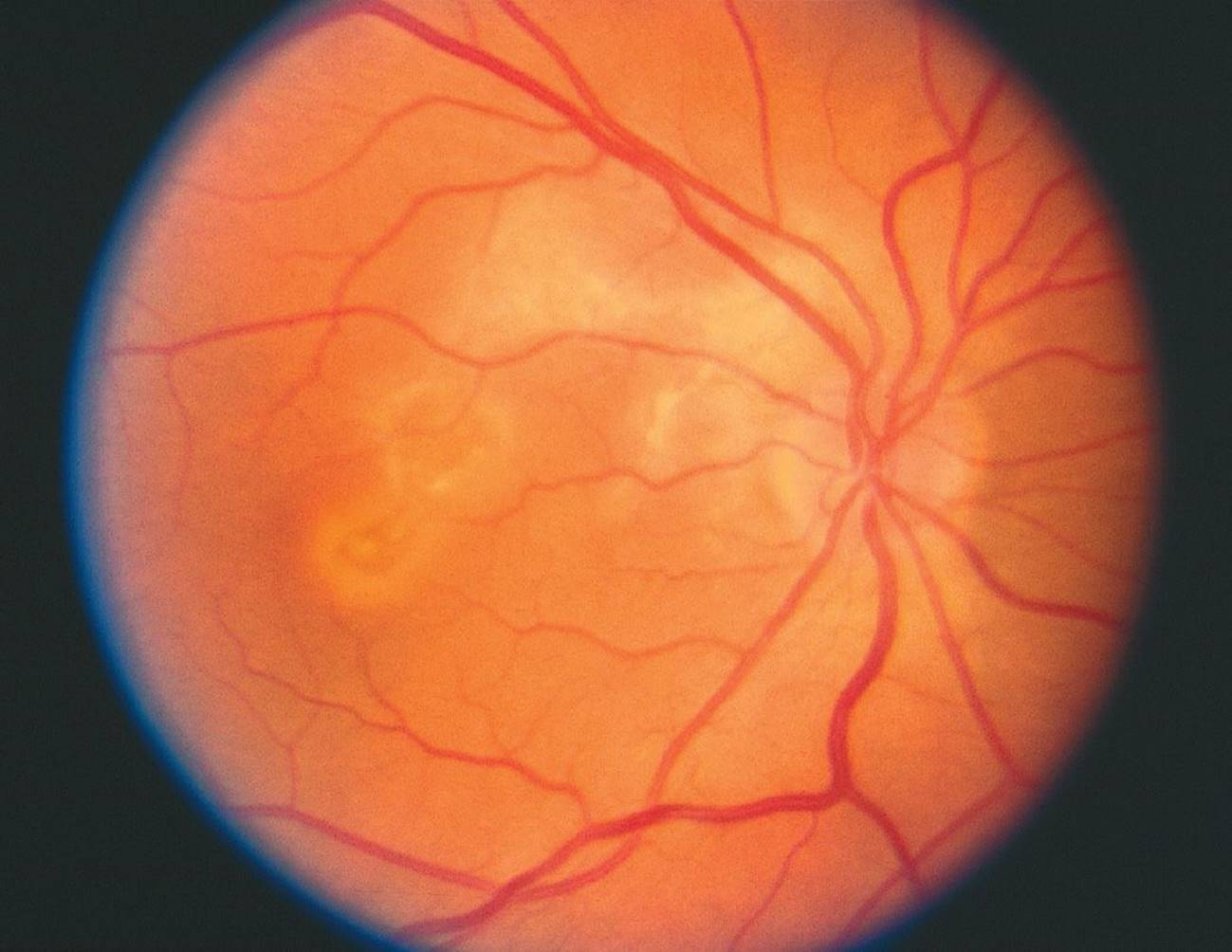 Uveitis - Review questions in ophthalmology