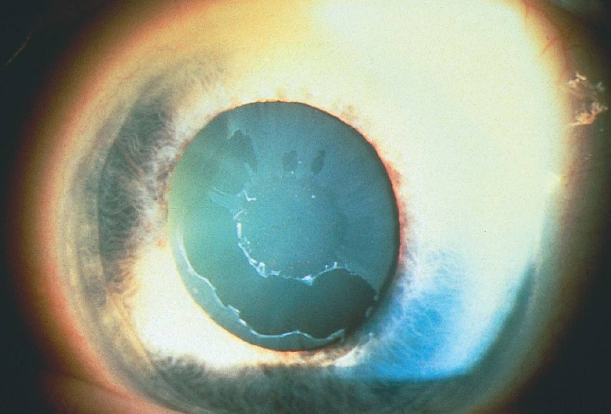 Glaucoma - Review questions in ophthalmology