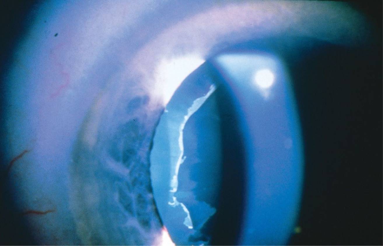 Lens/Cataract - Review questions in ophthalmology