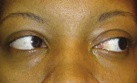 Neuro-ophthalmology - The Wills Eye Manual