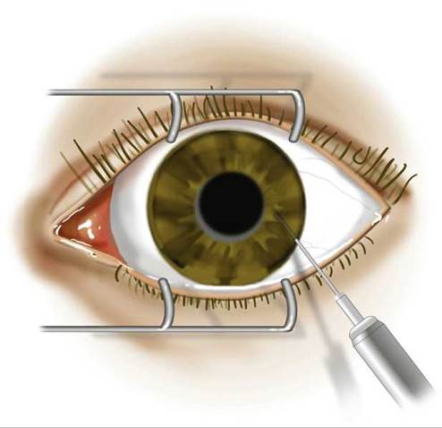 Appendices - The Wills Eye Manual