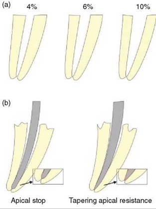 Vital Pulp Extirpation - Essential endodontology: prevention and ...