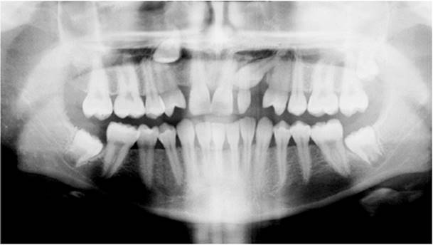 Canines - An Introduction to Orthodontics, 2nd Edition
