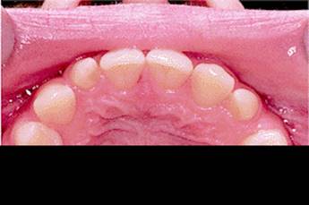 Canines - An Introduction to Orthodontics, 2nd Edition