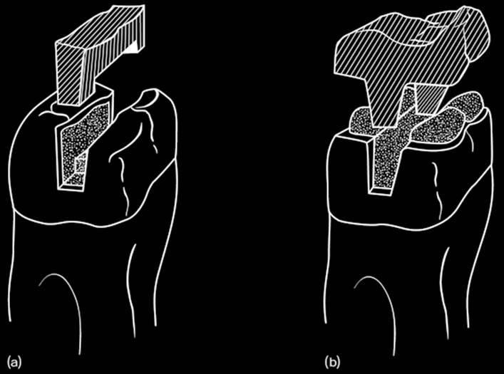 Principles of indirect restoration - Principles of operative dentistry