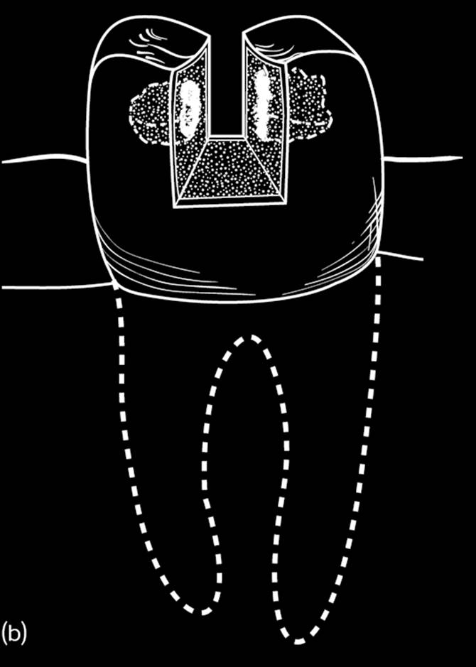 Principles of indirect restoration - Principles of operative dentistry