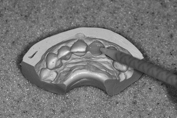 Indirect restorations – further considerations - Principles of ...