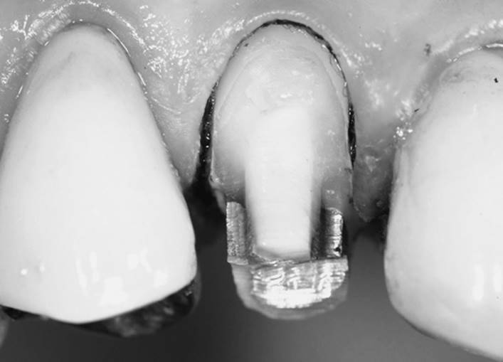 Indirect restorations – further considerations - Principles of ...