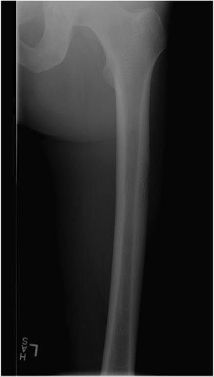 Orthopedic Infections: Basic Principles of Pathogenesis, Diagnosis, and ...