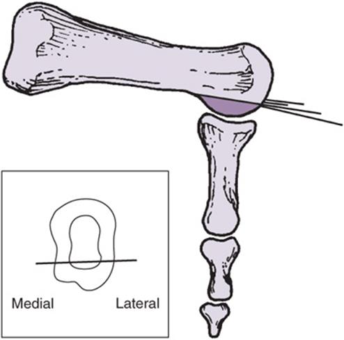 Foot and Ankle Surgery - Current Diagnosis & Treatment in Orthopedics ...