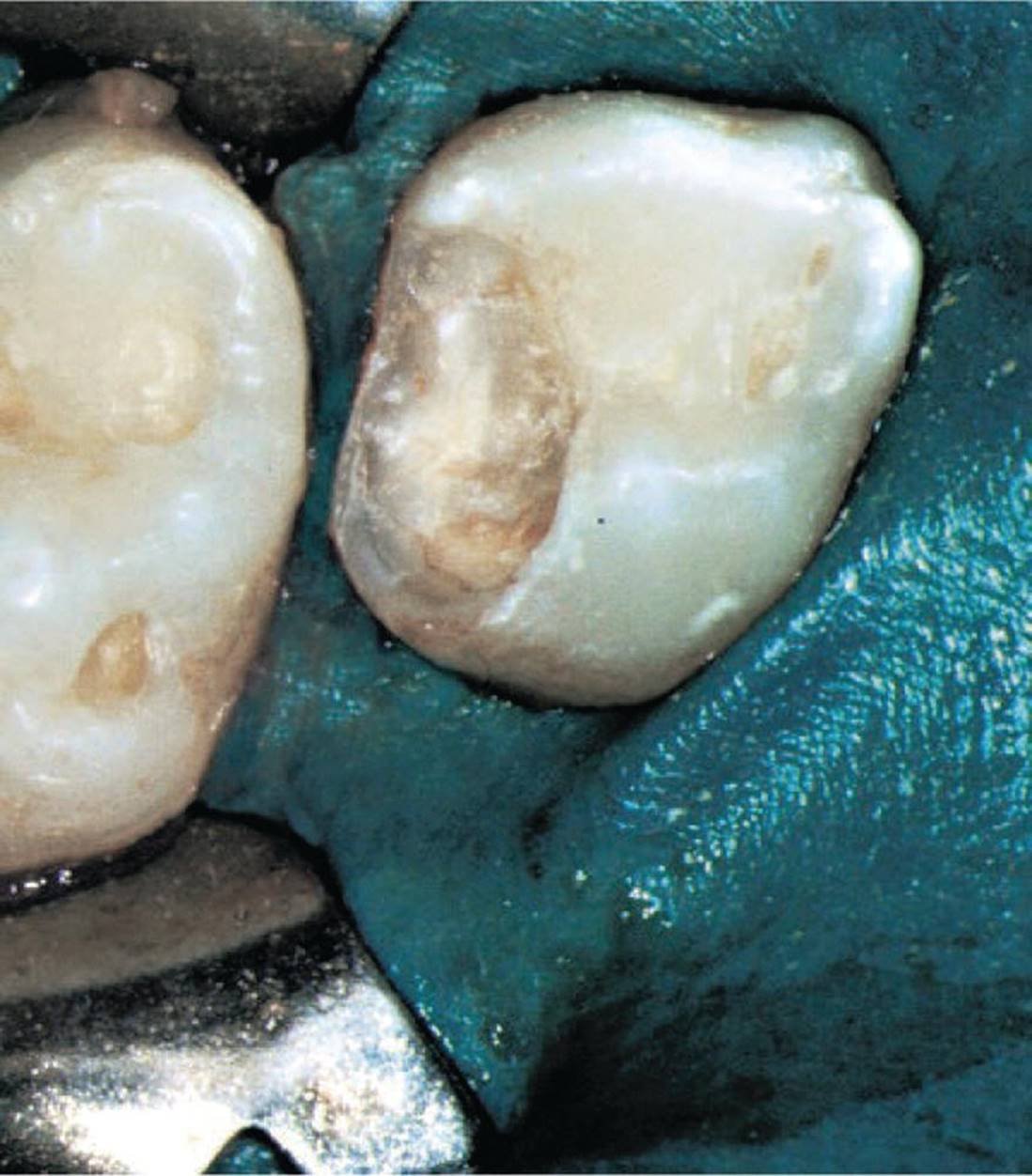 Diagnosis and Management of Dental Caries - Pediatric Dentistry - a ...