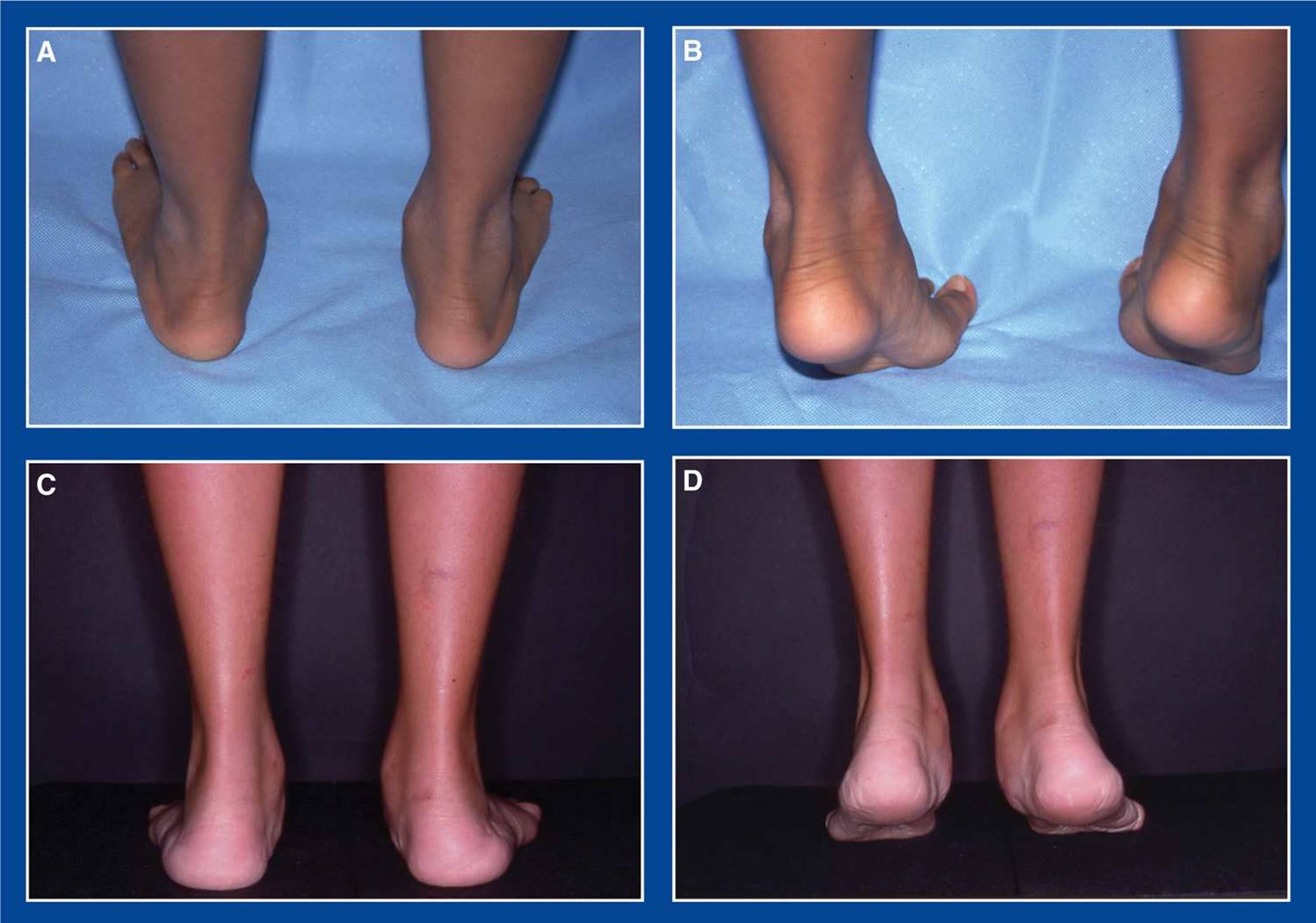 ASSESSMENT PRINCIPLES - Principles and Management of Pediatric Foot and ...